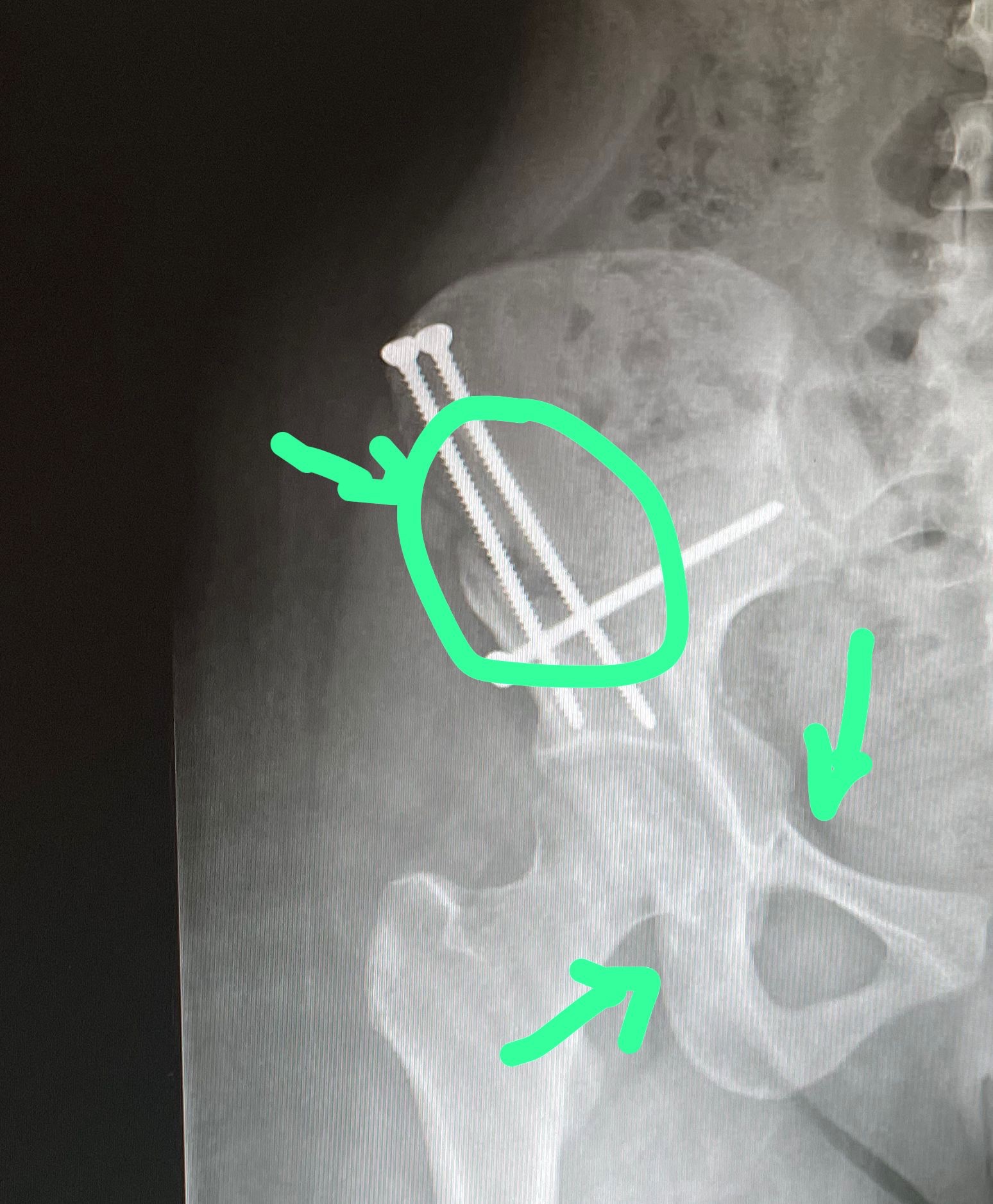 Dr. Ixchel’s Road To Recovery: Open Hip Reconstruction Surgery ...